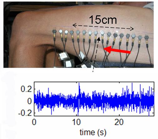 'Muscle noise' could reveal diseases' progression | New Scientist