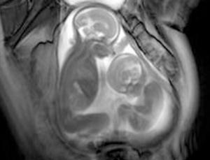 Unborn twins caught on video MRI for the first time | New Scientist