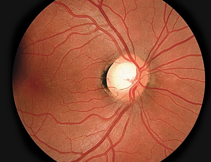 Eye implant turns smartphone into a glaucoma monitor | New Scientist