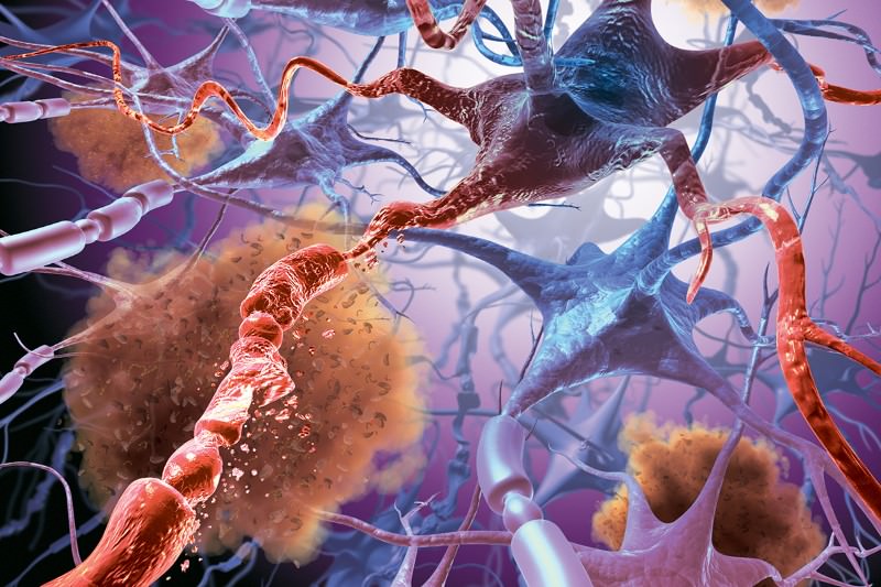 Iron levels in brain predict when people will get Alzheimer's | New ...